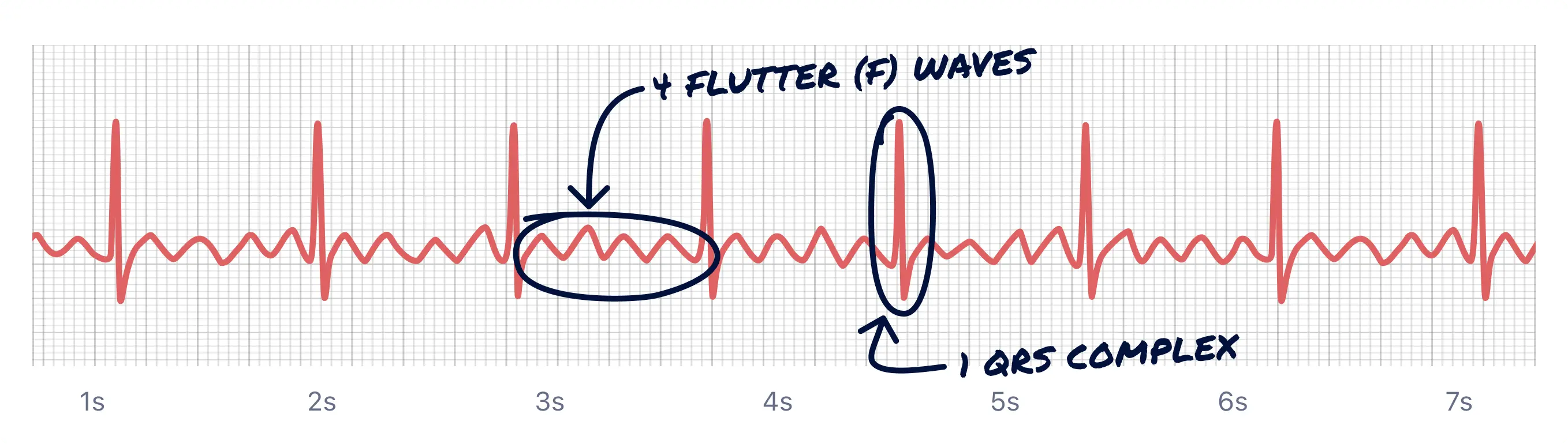 What Atrial Flutter Looks Like on Your Watch ECG | Qaly